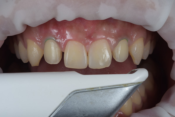 ラミネートベニア｜岡山の歯医者【きむら歯科医院】土曜診療